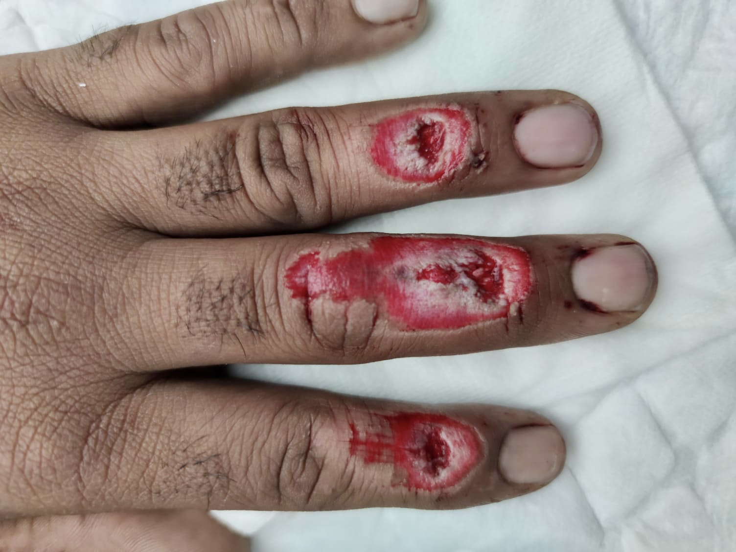 Infermeravirtual.com - Ferides i cremades, Problemes de salut